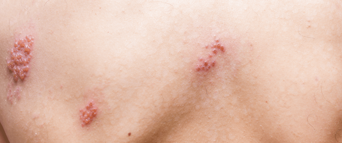 What Are Your Chances of Getting Shingles? – Health Life Magazine